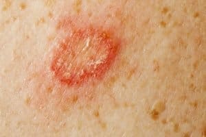 Infectious Skin Disease | Mona Dermatology