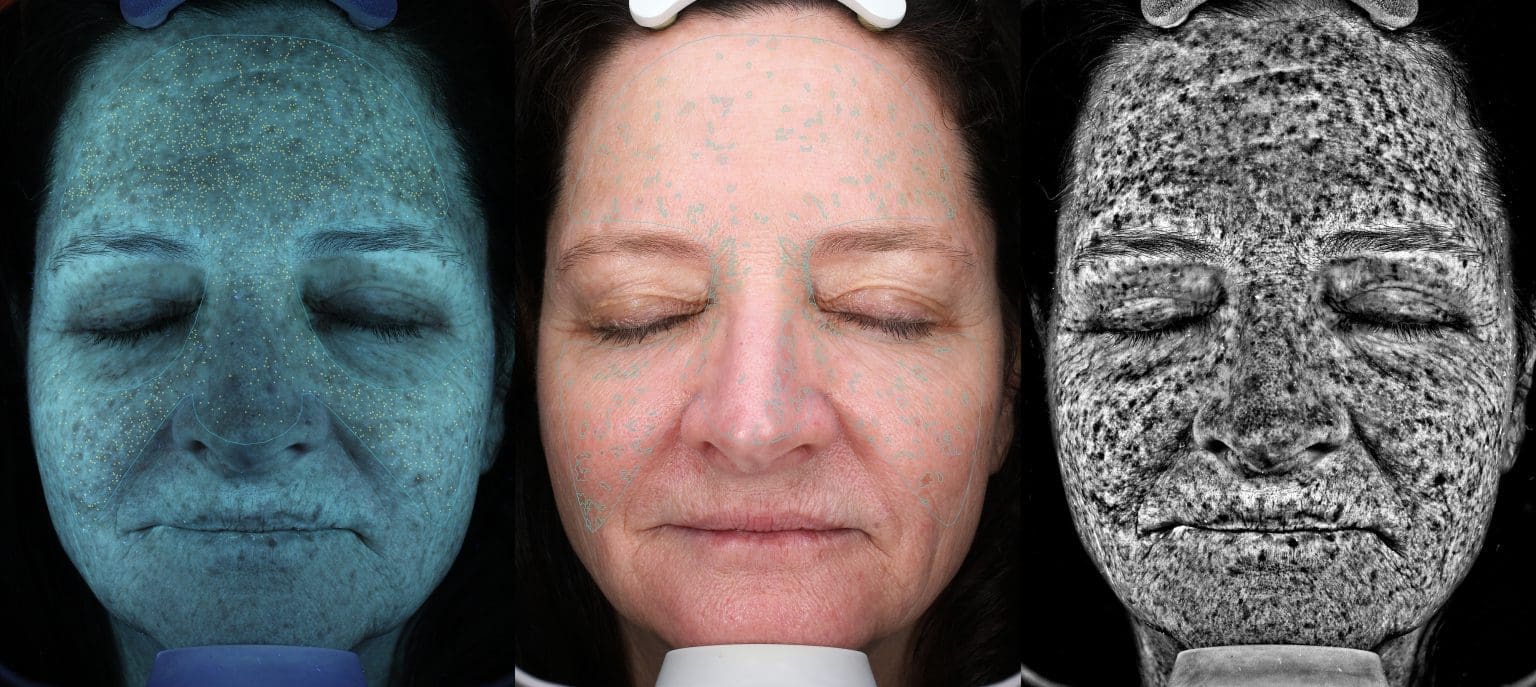 VISIA Complexion Analysis - Mona Dermatology
