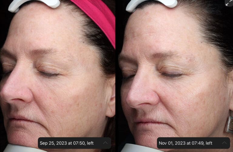 Skinvive Before & Afters | 5 Patient Stories - Mona Dermatology