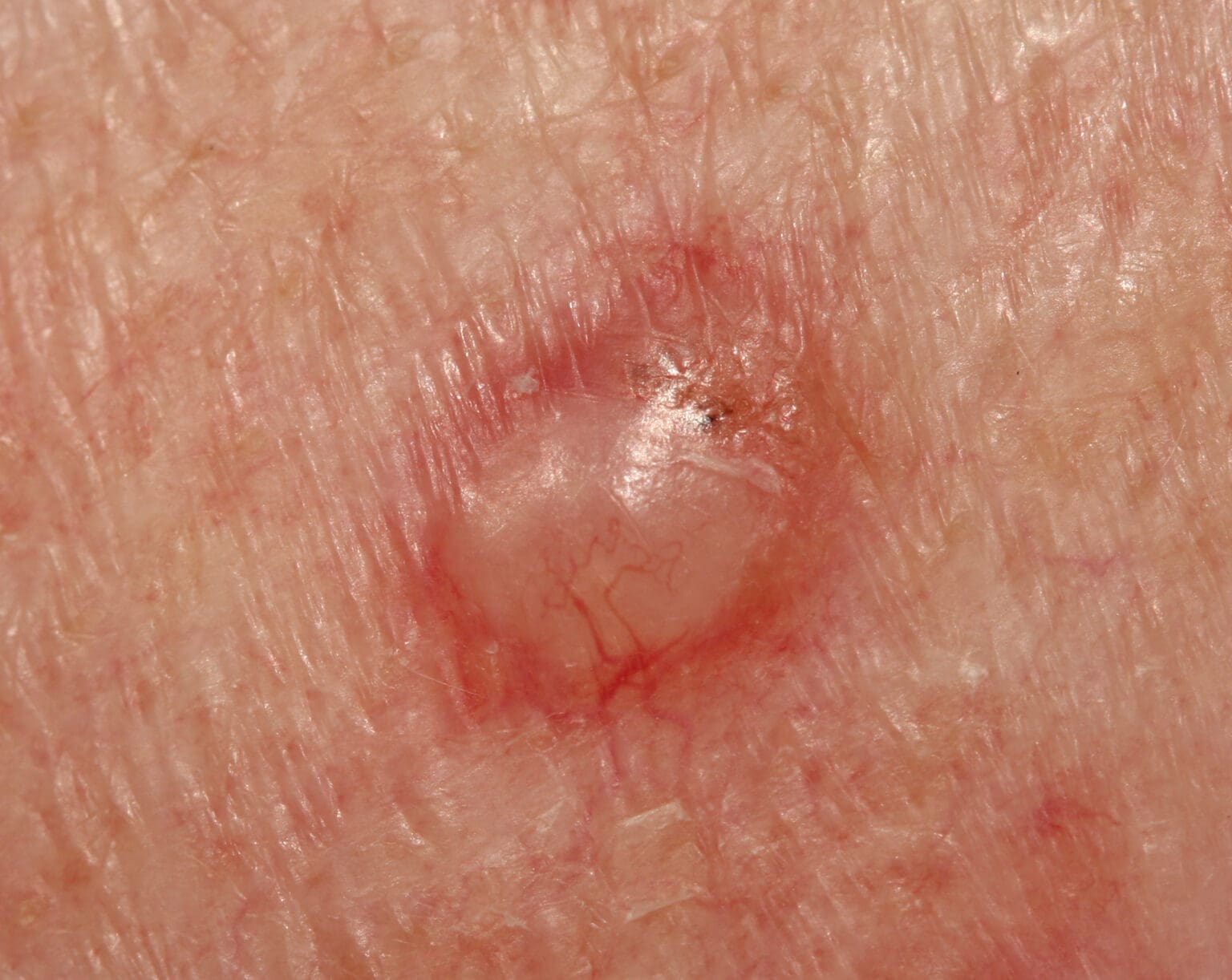 Identifying Skin Cancer Spots - Mona Dermatology