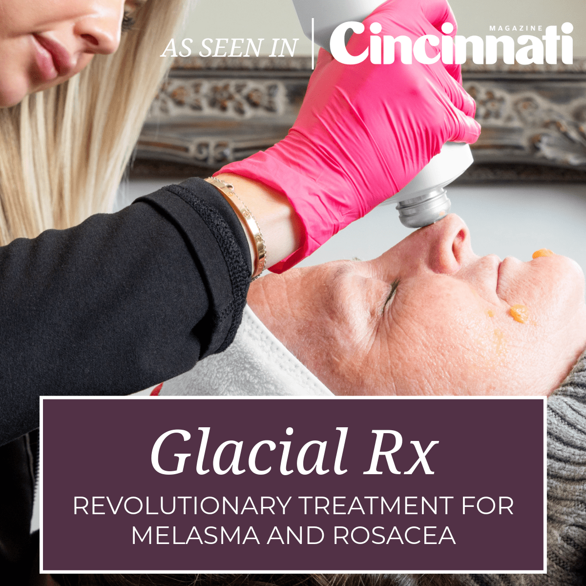 Glacial Rx For Melasma and Rosacea | As Seen in Cincinnati Magazine ...