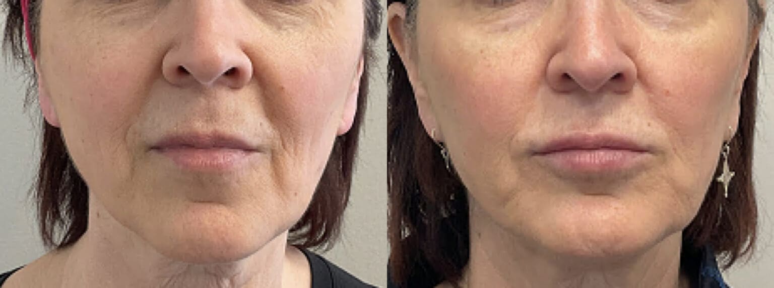 Cheek Filler Placement: How-To Guide - Mona Dermatology