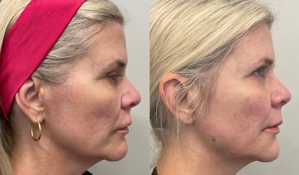 Cheek Filler Placement: How-To Guide - Mona Dermatology