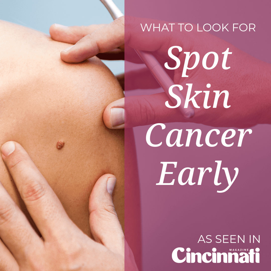 Spot Skin Cancer Early: What to Look For | As Seen in Cincinnati ...